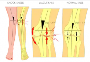 Dolor de rodilla | ¿qué tan importantes son las rodillas en nuestro cuerpo?