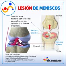 Dolor de rodilla ¿meniscos rotos? , ¿cuáles son los síntomas?