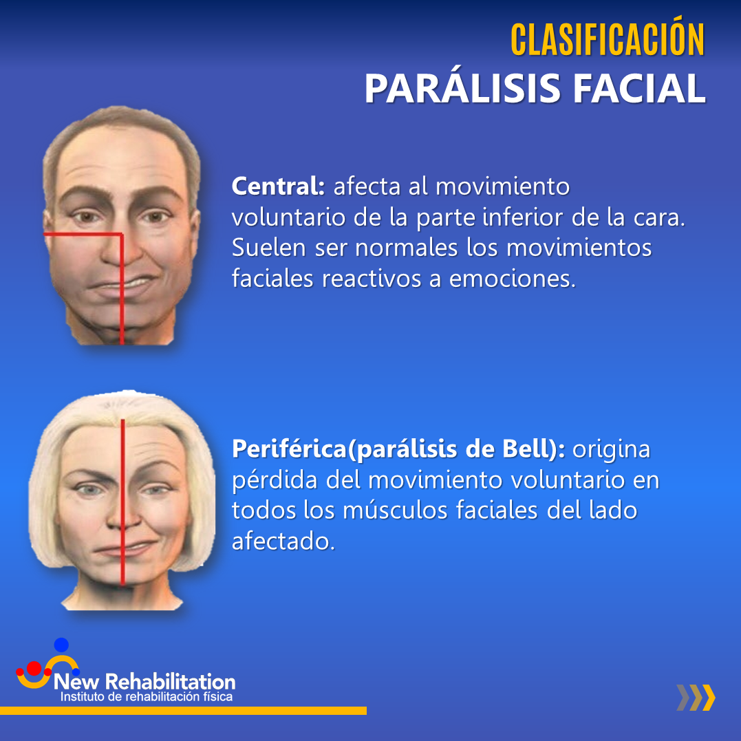 Parálisis facial, sus diferentes tipos y cómo recuperarte ...