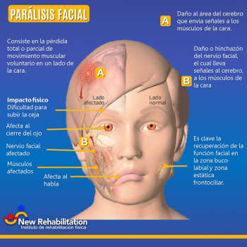 Parálisis facial, sus diferentes tipos y cómo recuperarte ...