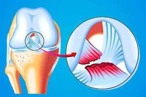 Lesión del Ligamento cruzado anterior - Tratamiento Postcirugía